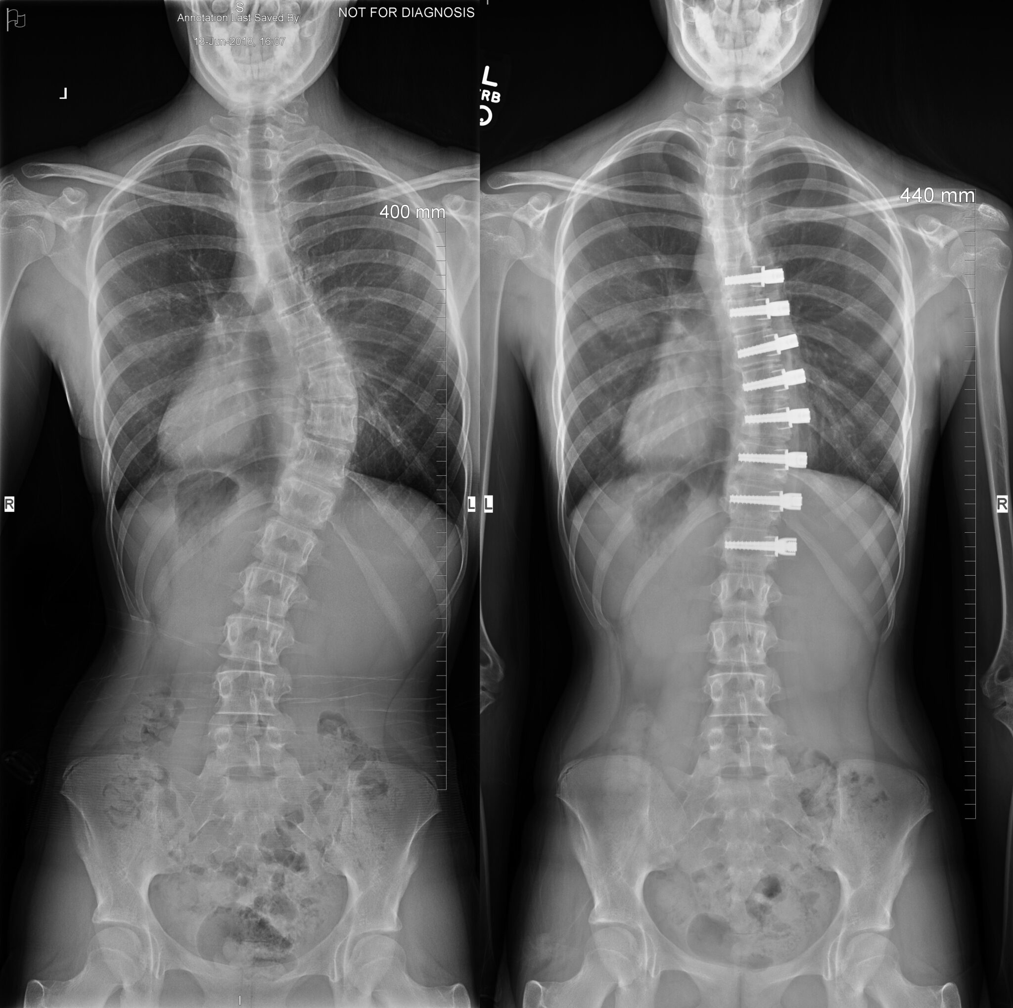 2021 Webinar - Vertebral Body Tethering - Setting Scoliosis Straight